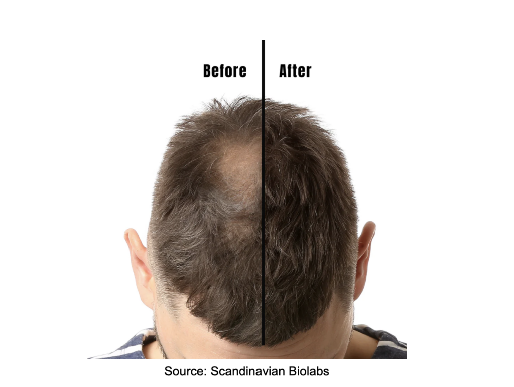 Does Minoxidil Work for a Receding Hairline? Before and After Results ...